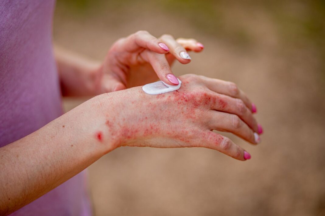 Your Guide to Choosing the Perfect Eczema Cream for Lasting Comfort ...